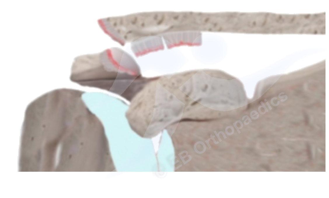 Orthopaedic & Trauma Surgeon - Shoulder - ACJ disruption