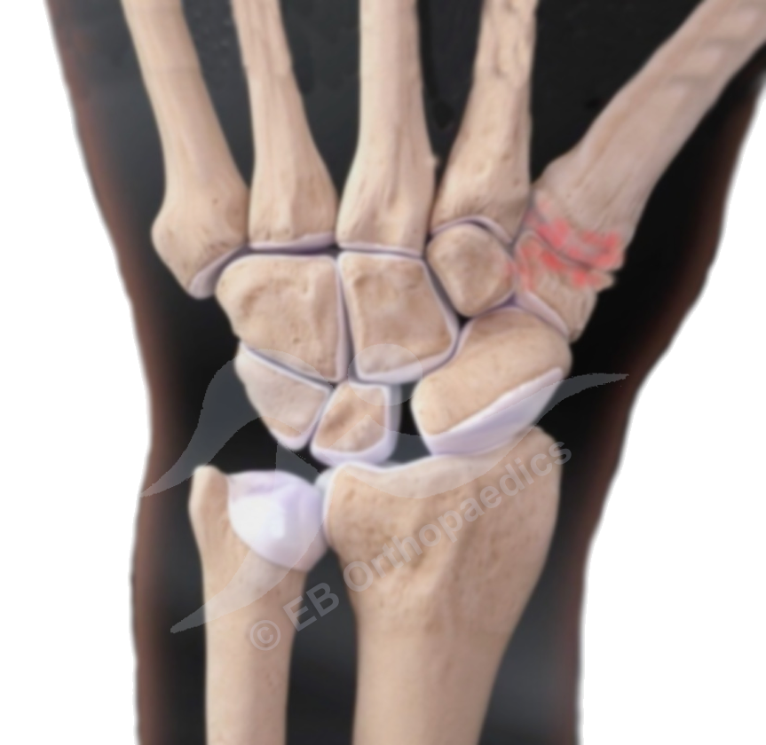 Orthopaedic & Trauma Surgeon - Hand - CMCJ arthritis