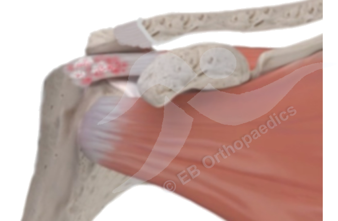 Orthopaedic & Trauma Surgeon - Shoulder - Calcific tendonitis