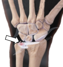 Wrist Surgeon Gloucestershire - Wrist Clinic